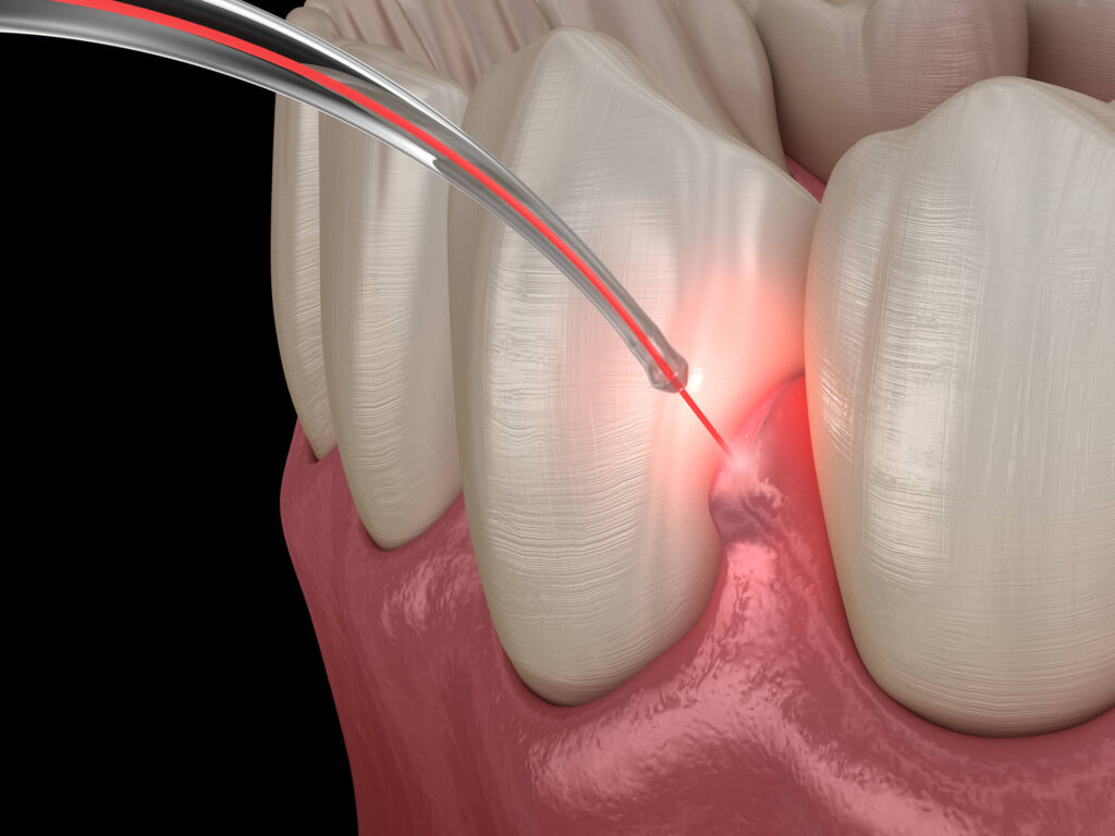 Laser Dentistry for Gum Health: Treating Periodontal Issues Safely